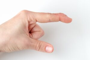 Treatments for Finger Deformity - Hand and Wrist Surgeons in Guildford