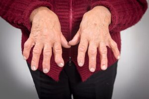 Treatments for Finger Deformity - Hand and Wrist Surgeons in Guildford