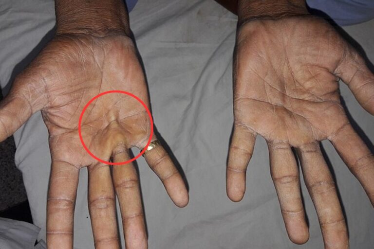 Treatments for Finger Deformity - Hand and Wrist Surgeons in Guildford