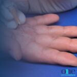 Treatments for Finger Deformity - Hand and Wrist Surgeons in Guildford