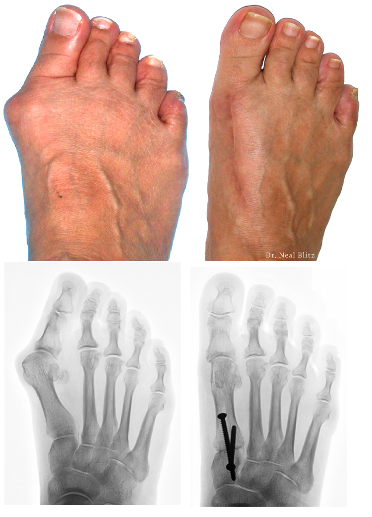 Private Keyhole Bunion Surgery in Surrey | One Orthopaedics