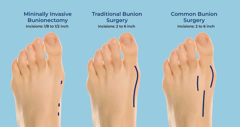 Private Keyhole Bunion Surgery in Surrey | One Orthopaedics