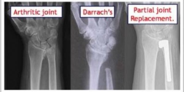 Darrach's Procedure | Hand And Wrist Treatment | Book Online